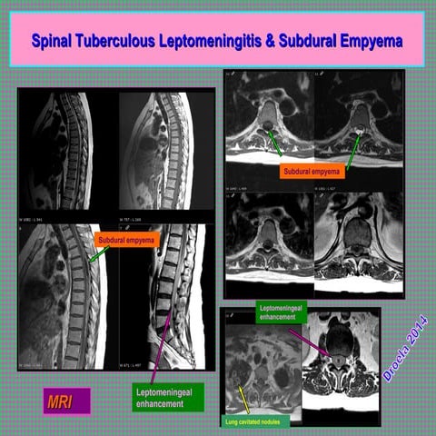 Spinal tuberculous leptomeningitis & subdural empyema & lately ...