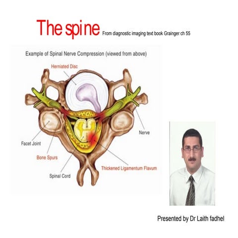 Intervertebral disc prolapse(ivdp) | PPTX