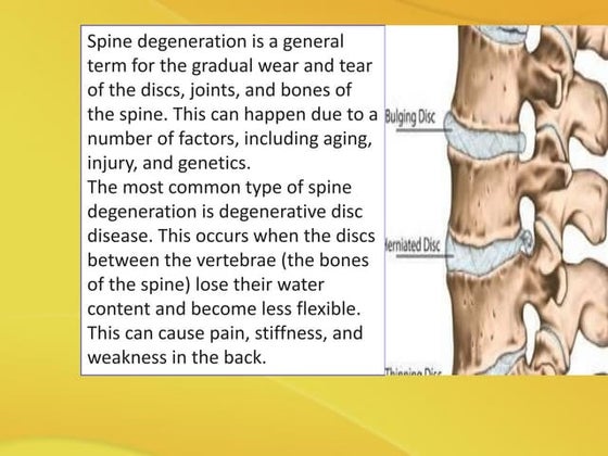 Degenerative-Joint-Disease-DJD-Cervical-Spondylosis-A-Comprehensive ...