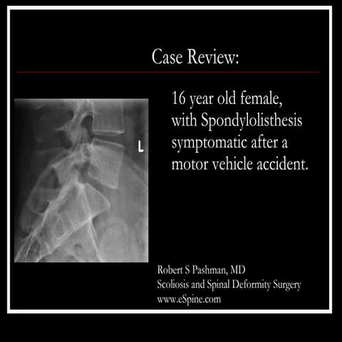 Case Review: 42 year old woman with Grade 3 Isthmic Spondylolisthesis | PDF