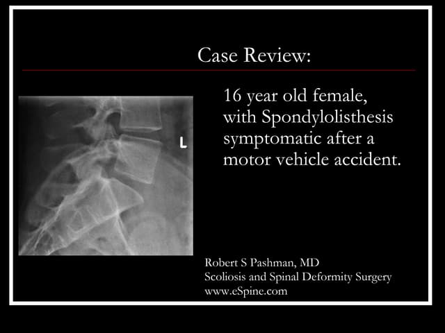 Case Review 28 Patient With Lumbar Scoliosis Status Post Surgery With