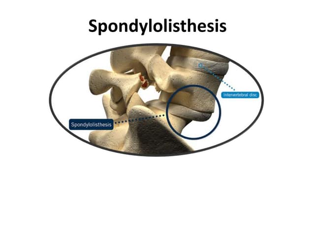 spondylolisthesis | PPT