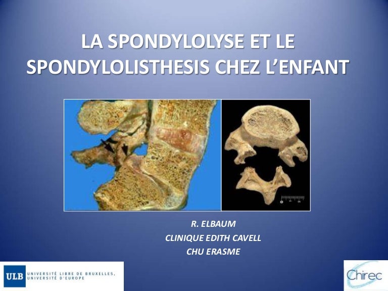 Spondylolyse chez l'enfant