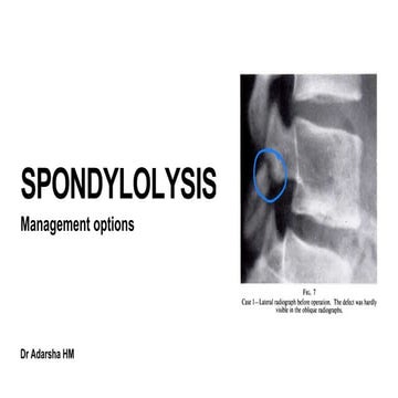 Spondylolysis.pptx by Dr Adarsha HM, Orthopaedic Spine Surgeon | PPTX
