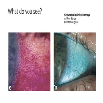 Spot Diagnosis - Look at the pictures-What do you See - Dry Eye.pptx
