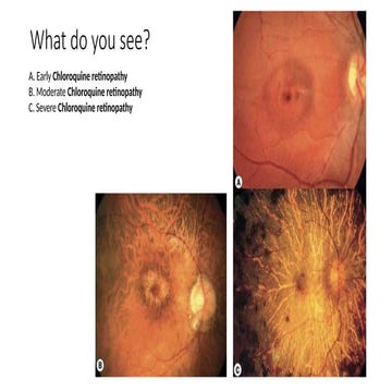 Spot Diagnosis - Look at the pictures-What do you See - Ophthalmic Side ...