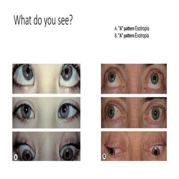 Spot Diagnosis - Look at the pictures-What do you See - Strabismus.pptx