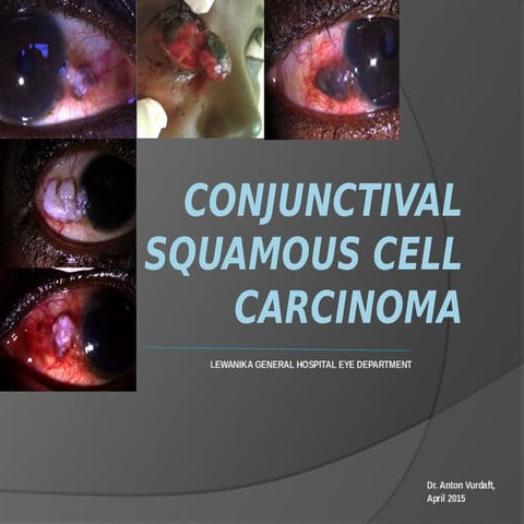 Conjunctival Squamous Cell Carcinoma | PDF