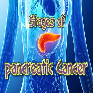 Stages of Pancreatic Cancer | PDF | Endocrine and Metabolic Diseases ...