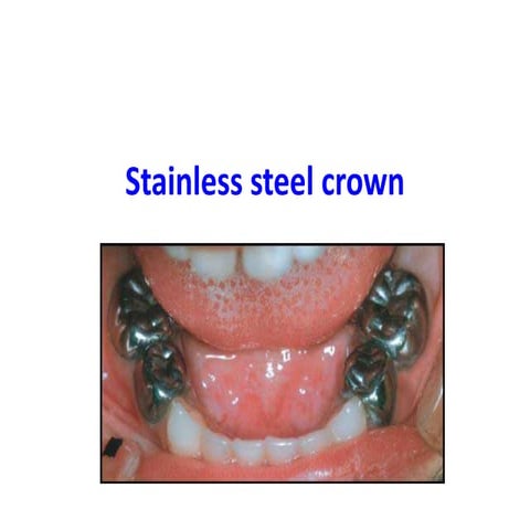 Stainless steel crown .pptx