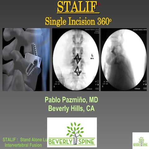 Lumbar Fusion : A New Anterior Only Option. The STALIF | PPT