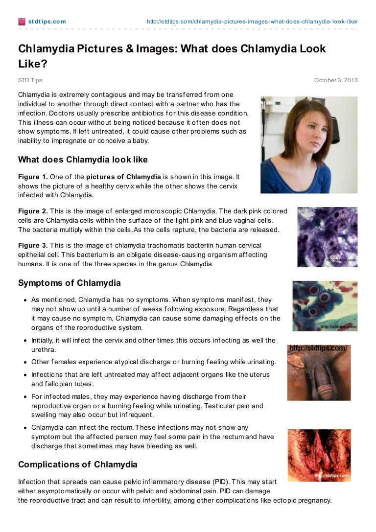 Chlamydia Pictures Amp Images What Does Chlamydia Look Li…