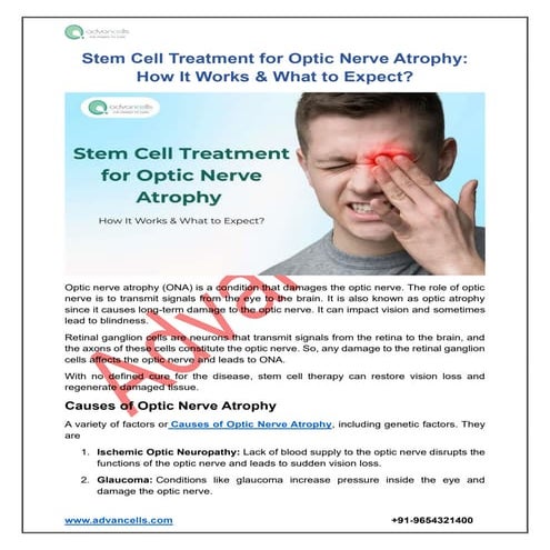 Stem Cell Therapy Treatment for Optic Nerve Atrophy | PDF