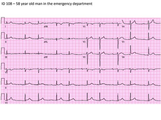 ECG - Mobitz Type II block | PPT