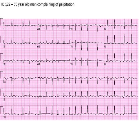 Stepwise interpretation of ECG ID122 | PPT