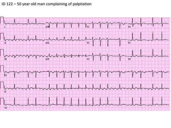 Stepwise interpretation ECG #12 | PPT