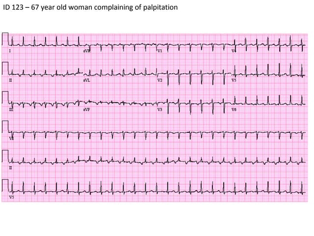 ECG #13 - ID 419 - EAR IRBBB | PPT