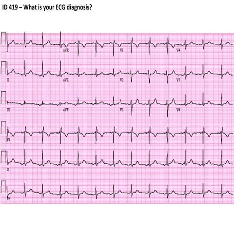 Stepwise interpretation of ECG - #3 ID659 | PPTX