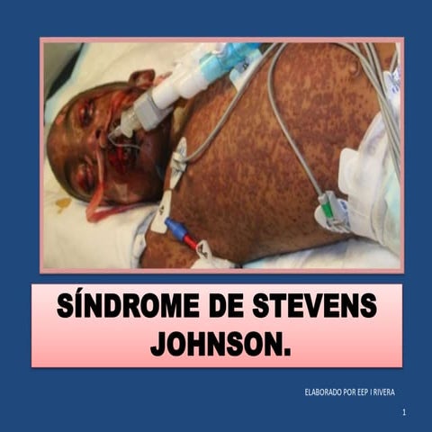 Stevens Johnson Y Necrolisis Epidermica Toxica | PPTX