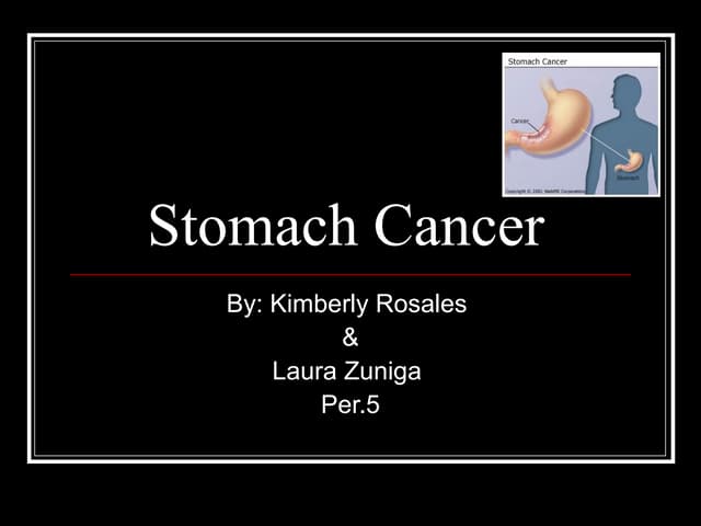 Stomach Cancer | PPT