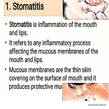 stomatitis | PDF