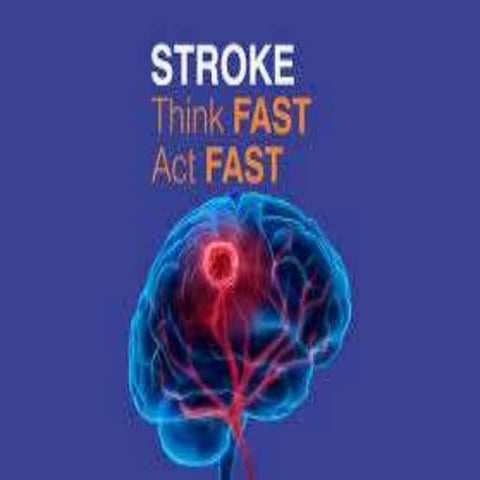 STROKE.pptx