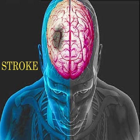 stroke and its types and management .pptx