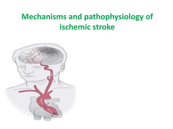 Approach to a patient with stroke - Pathophysiology of stroke | PPT