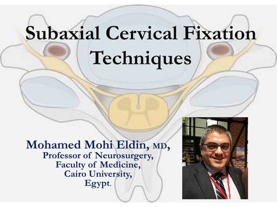 Expansive laminoplasty in cervical canal stenosis | PPT