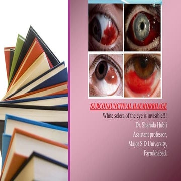 Subconjunctival Haemorrhage,causes,treatment..pptx