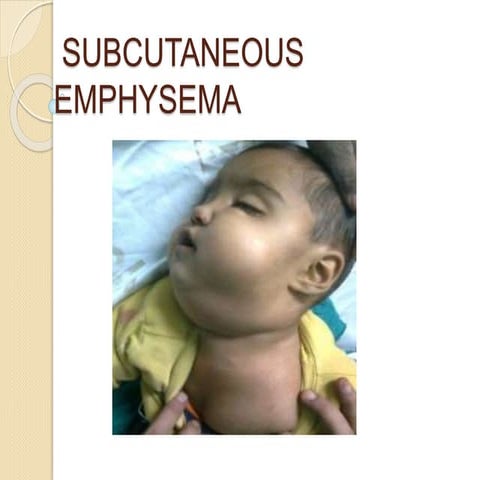 Subcutaneous emphysema | PPTX