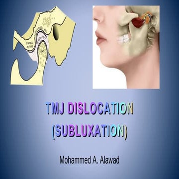 Subluxation (TMJ disorder) | PPSX
