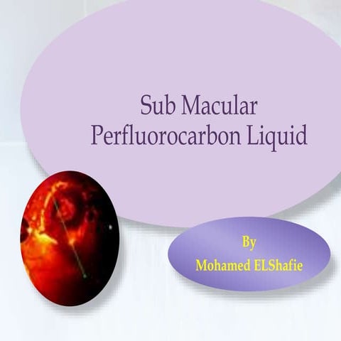 Subretinal perfluorocarbon liquid case report | PPT