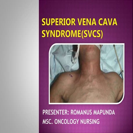 Superior Vena Cava Syndrome Etiology And Management Ppt