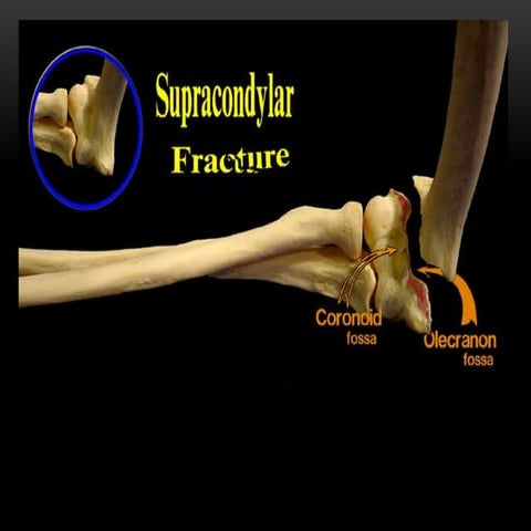 Supra condylar fracture.pptx