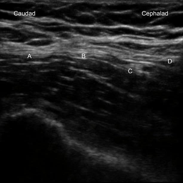 Supraingiunal FICB | PDF