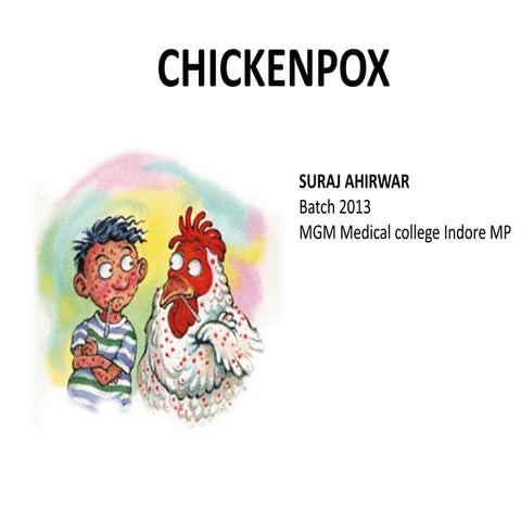 CHICKENPOX ppt | PPTX