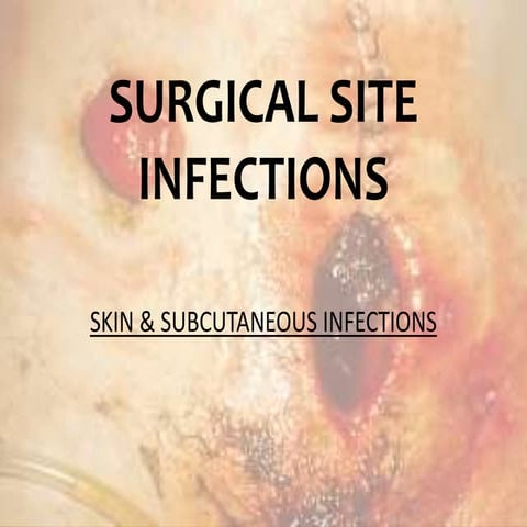SURGICAL SITE INFECTIONS - General Surgery.pptx