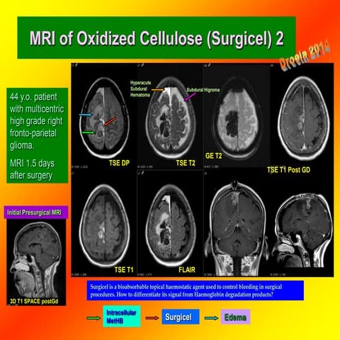 Surgicel MRI 2 | PPT