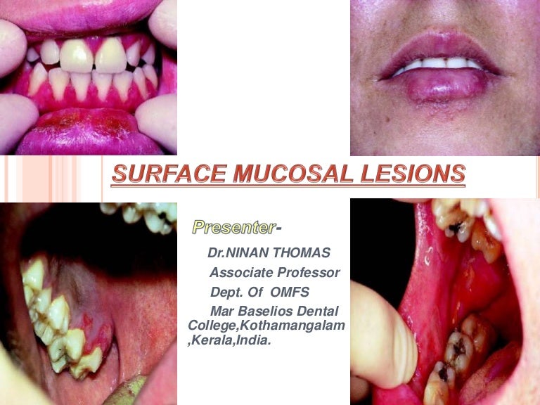 What Is A Mucosal Lesion: Causes Of Mucosal Disorder – BPJN