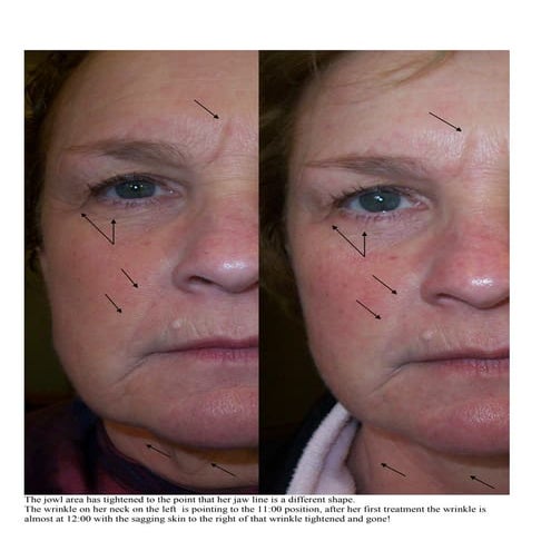Many before and after photos showing the power of ageLOC technology