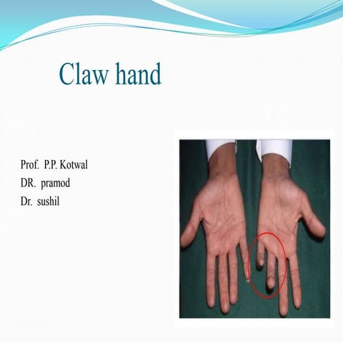 Susil seminar claw hand | PPTX