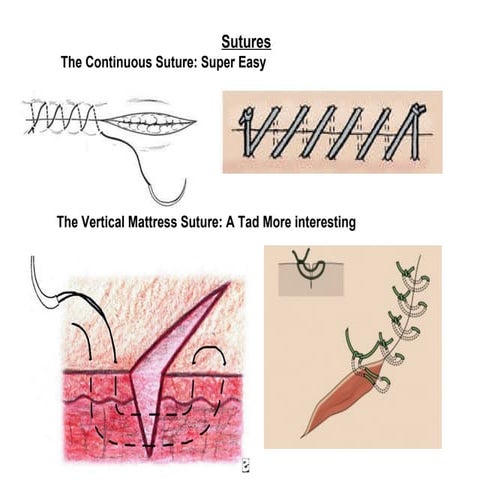 Sutures 1 4 | PPT