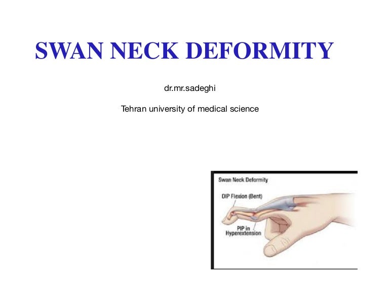 Swan Neck Deformity And Hand Surgery