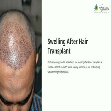 Swelling after hair transplant.pptx.pptx
