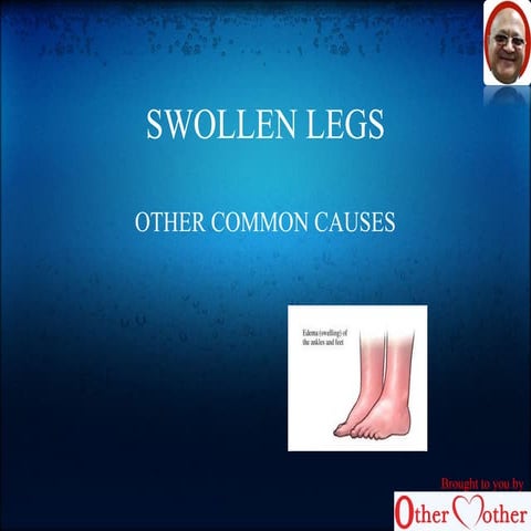 Swollen legs | PPT