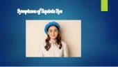 Strabismus | PPTX