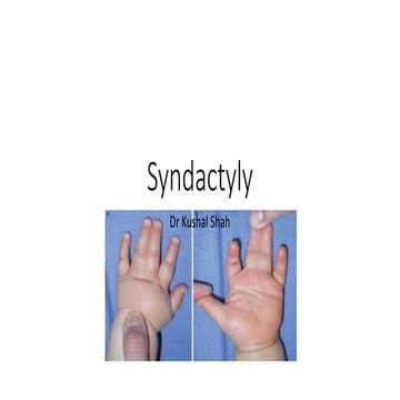 Syndactyly Hand | PPT