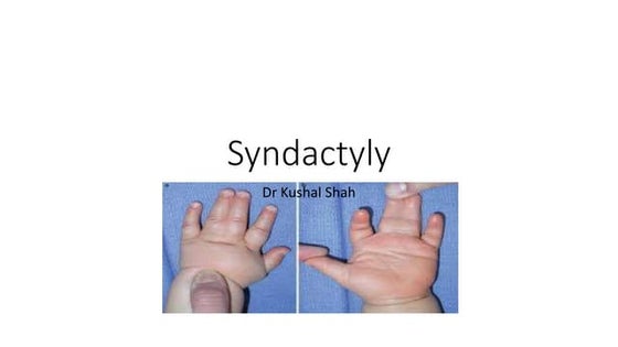 Syndactyly | PPTX