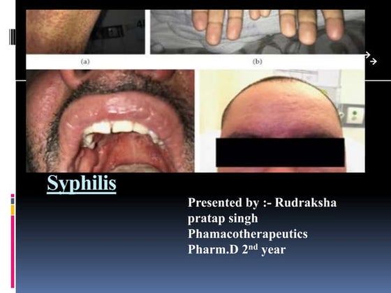 Syphilis | PPTX | Infectious Diseases | Diseases and Conditions